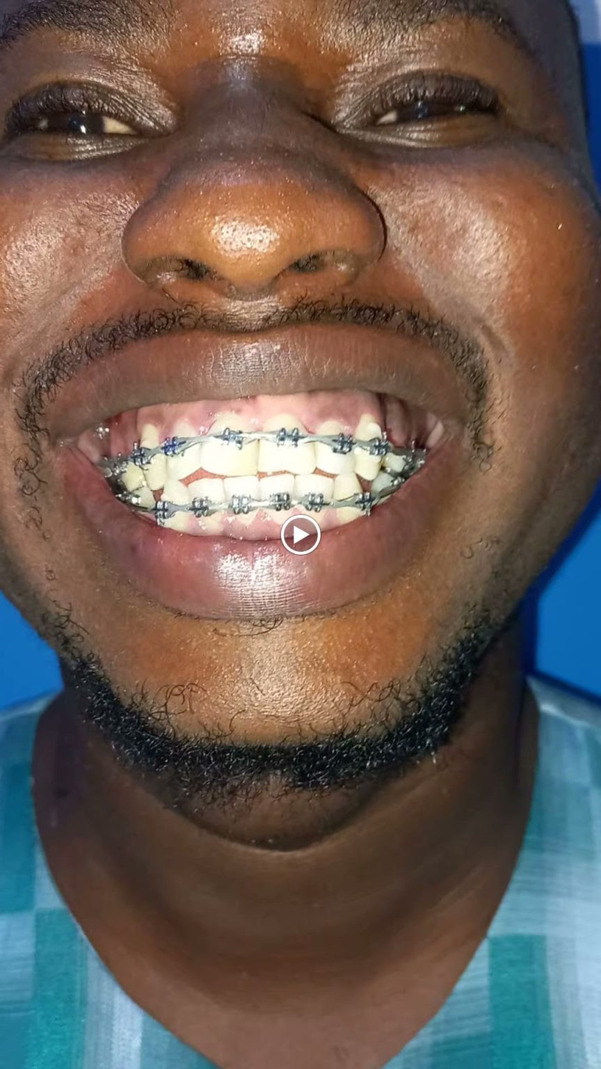 De-Crystal Dental Clinics Lagos | Dental Cleaning | Dental Impant ...